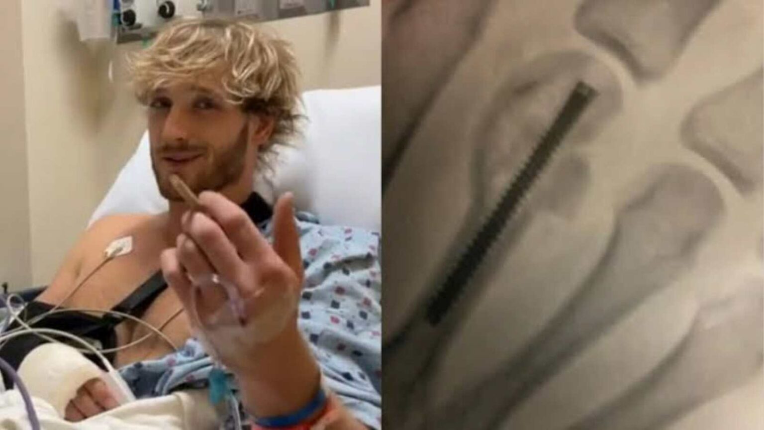 Logan Paul accused of having "steel pins" in his hand just before his ...