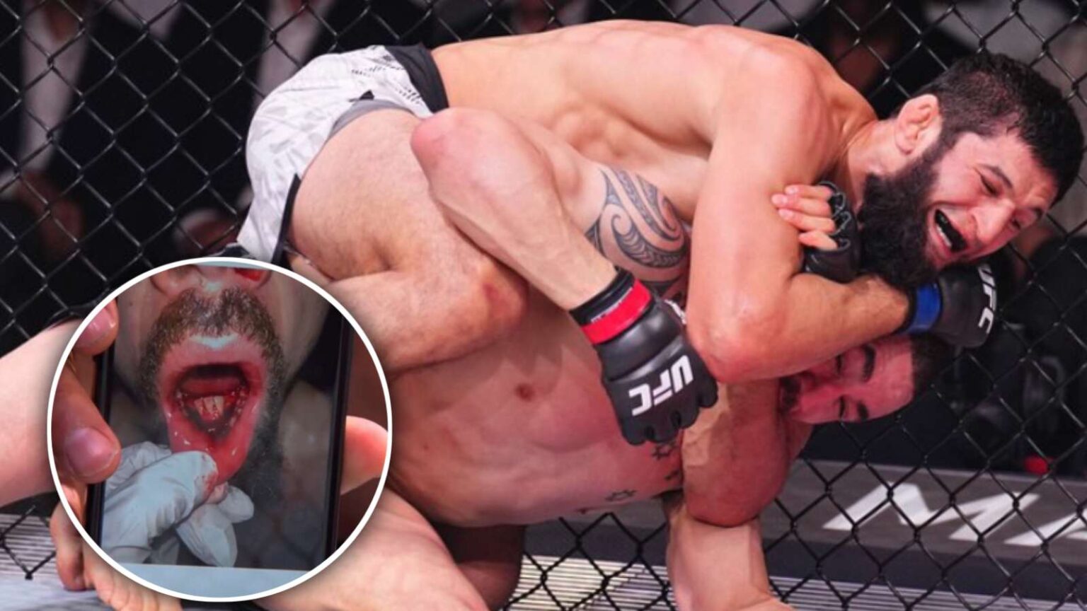 GRAPHIC image of Robert Whittaker's jaw broken down by sports doctor ...